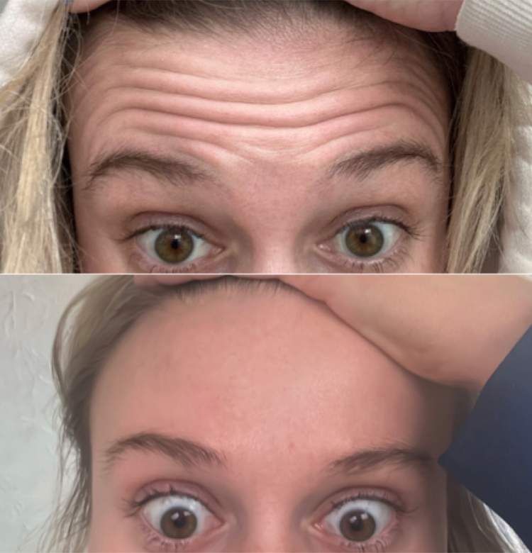 BOTOX Lansdowne | BOTOX Cosmetic Leesburg, VA | Virginia Eye